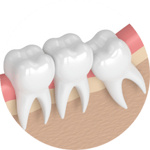 Wisdom Teeth - New Orleans Childrens Dental Center
