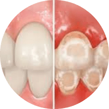 Improved Oral Hygiene in the Orthodontic Patient - New Orleans ...