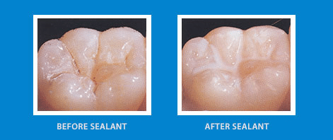Dental Sealants: Preventive is Better - New Orleans Childrens Dental Center
